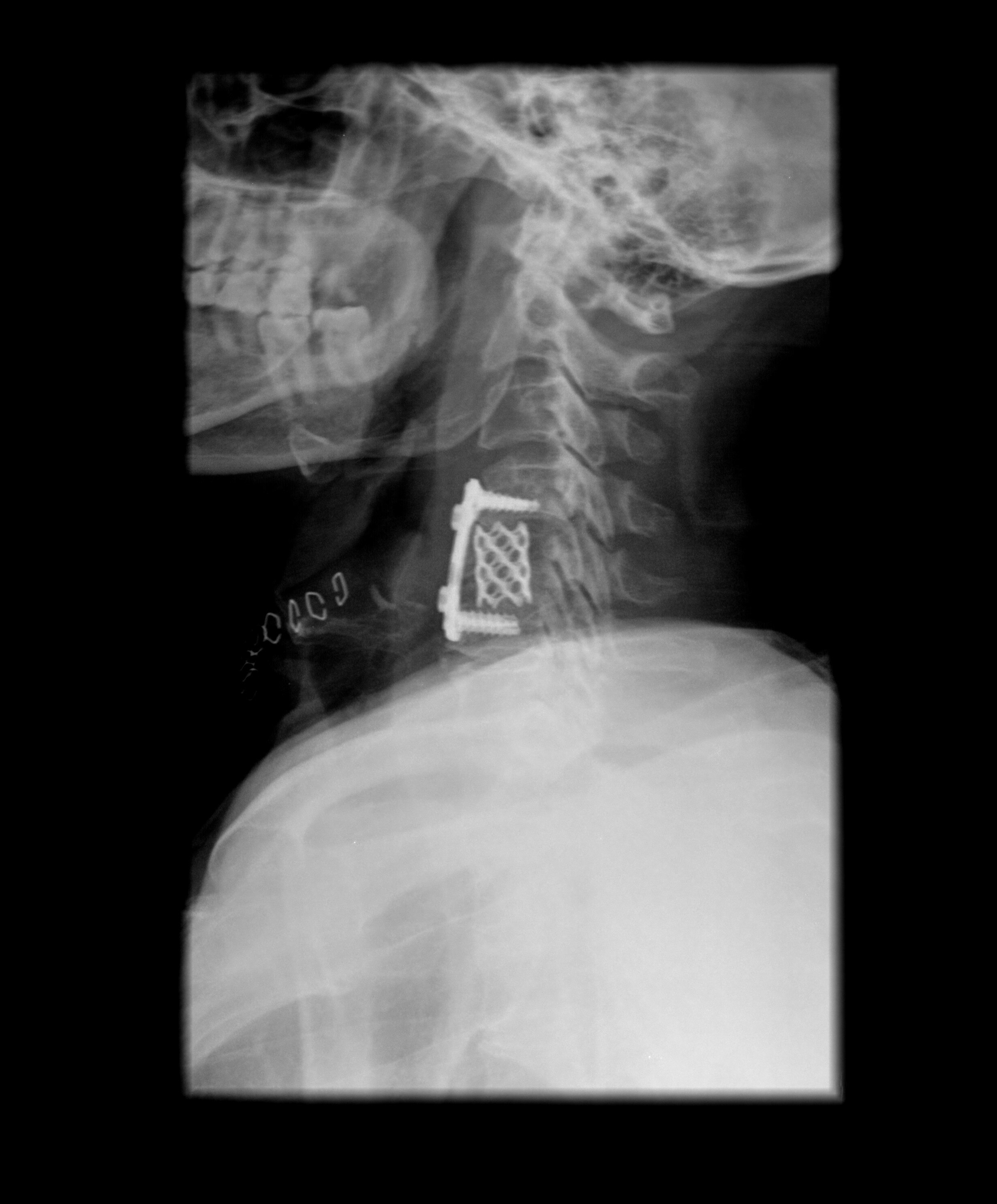 Cervical Spine Hardware Failure Icd 10 At Noah Weber Blog