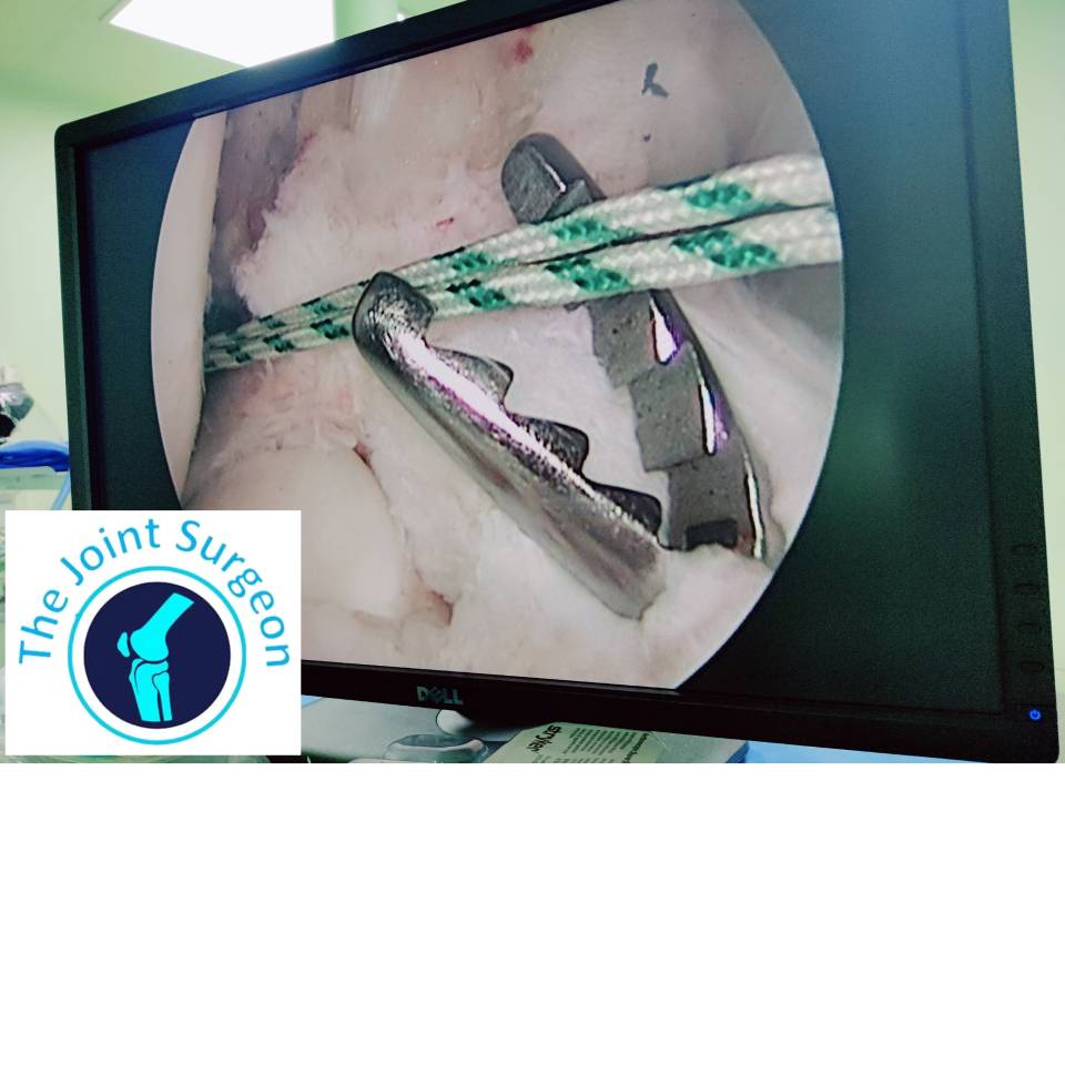 Book ALL INSIDE ARTHROSCOPIC ACL RECONSTRUCTION Treatments by Dr Vikas ...