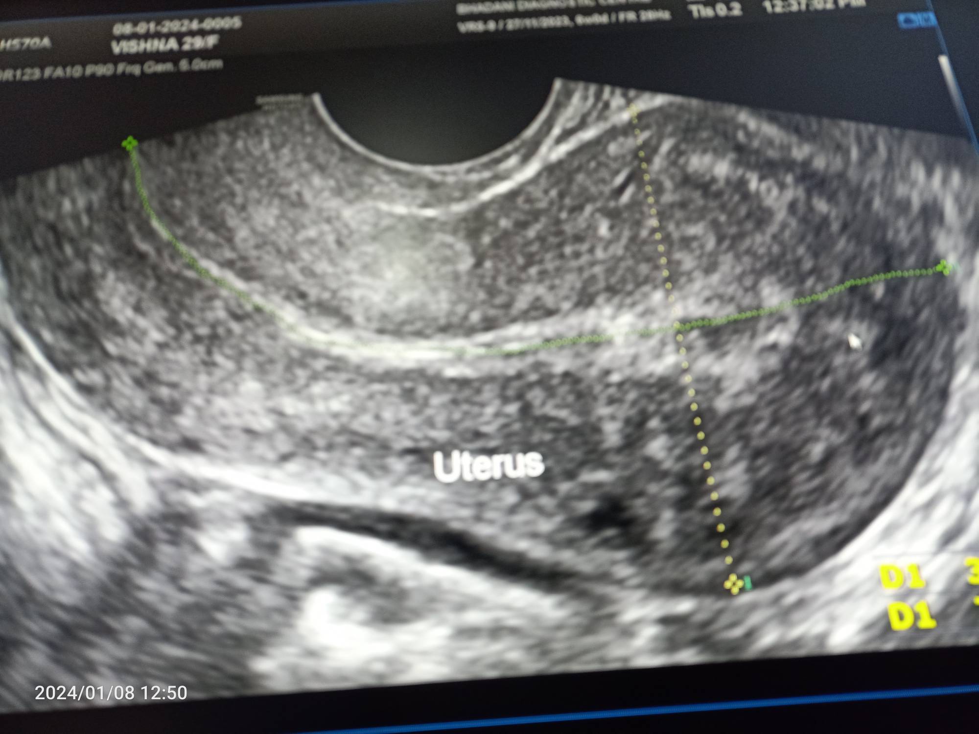 Transvaginal Sonography (TVS) - Bhadani Diagnostic Centre, New Delhi